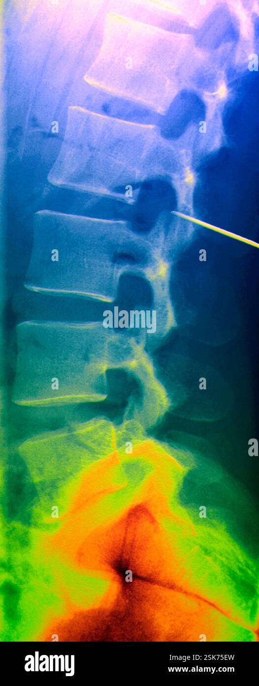 Corticosteroid therapy. Coloured X-ray of a patient receiving ...