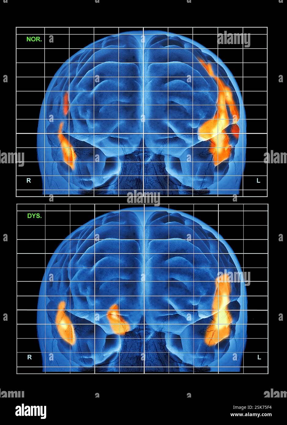 Brain activity during reading aloud in a normal (top) and dyslexic ...