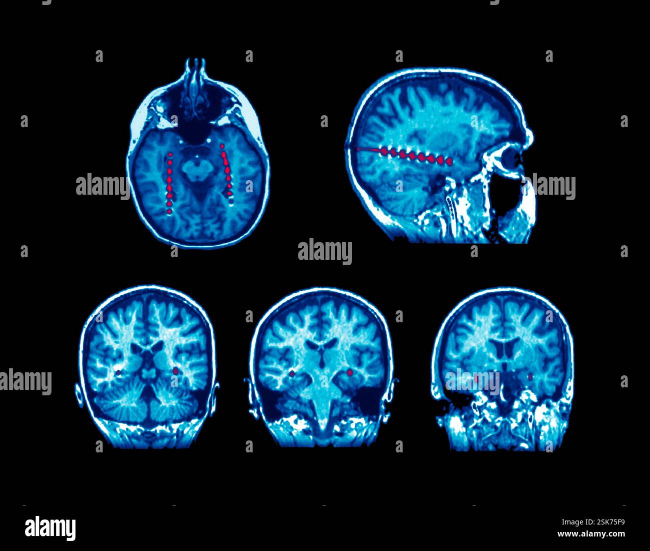 Treatment of epilepsy. Coloured magnetic resonance imaging (MRI) scans ...