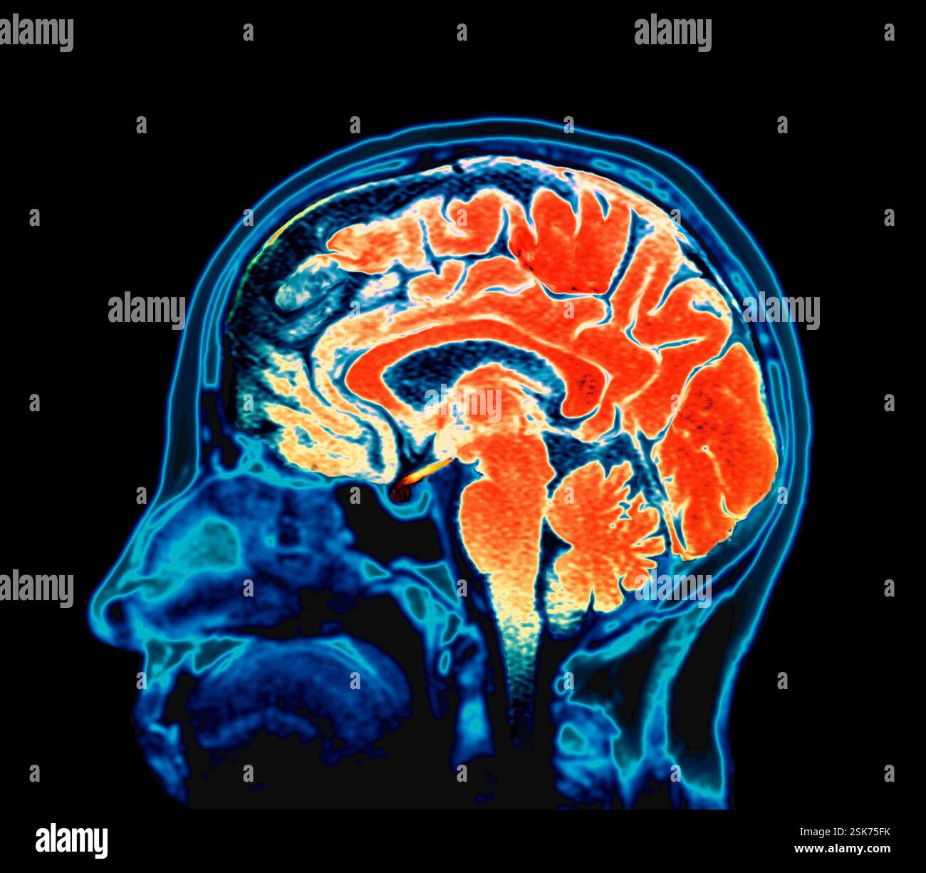 Brain, MRI scan Stock Photo - Alamy