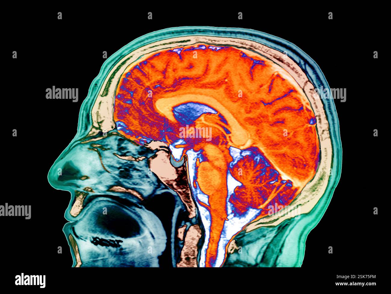 Normal human brain, coloured magnetic resonance imaging (MRI) scan. The front of the head is at ...