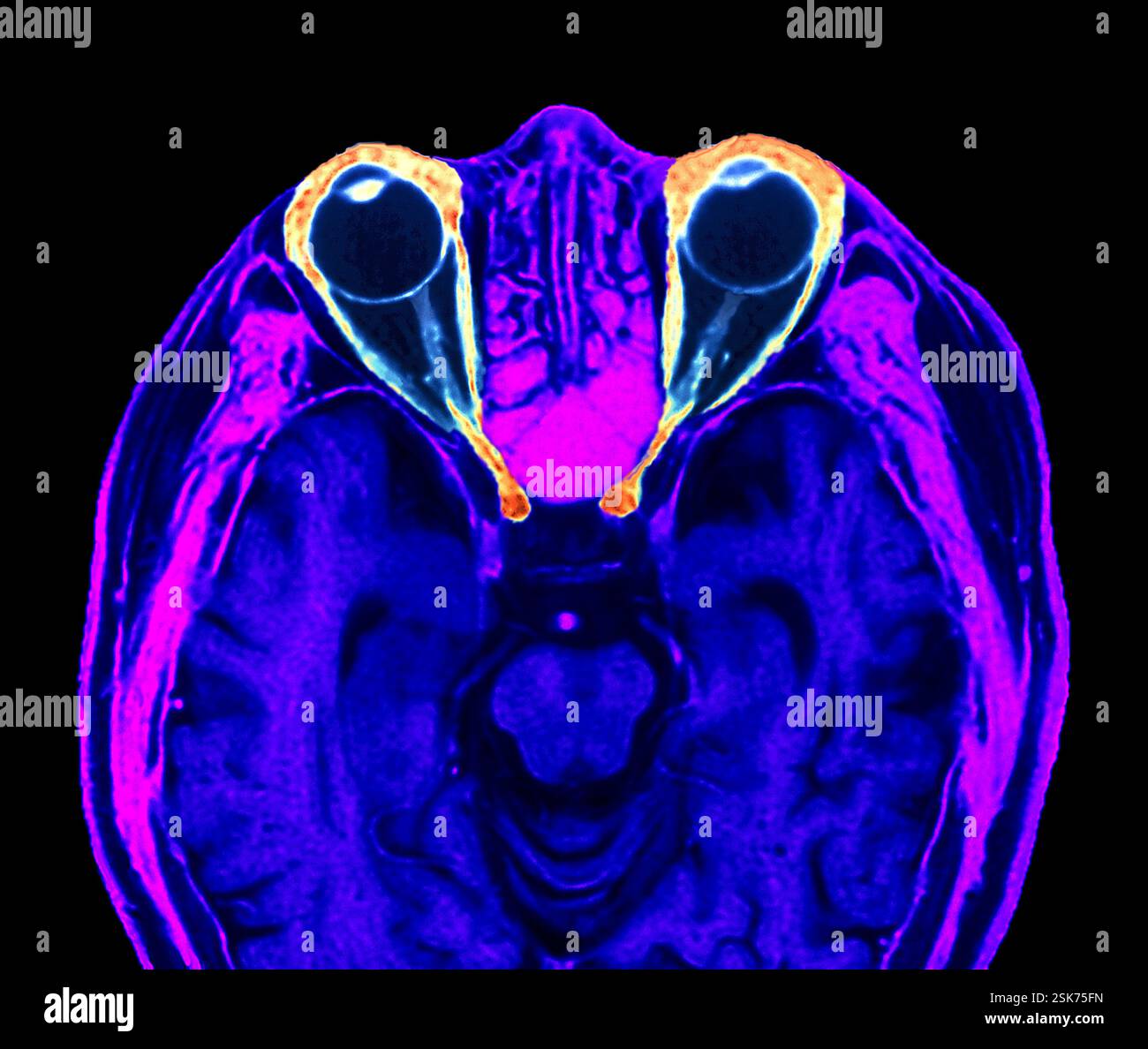 Eyes, optic nerves and brain, MRI scan Stock Photo - Alamy