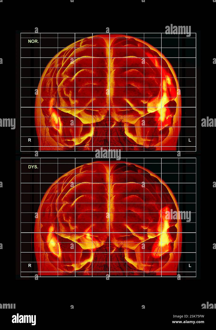 Brain activity during reading aloud in a normal (top) and dyslexic ...