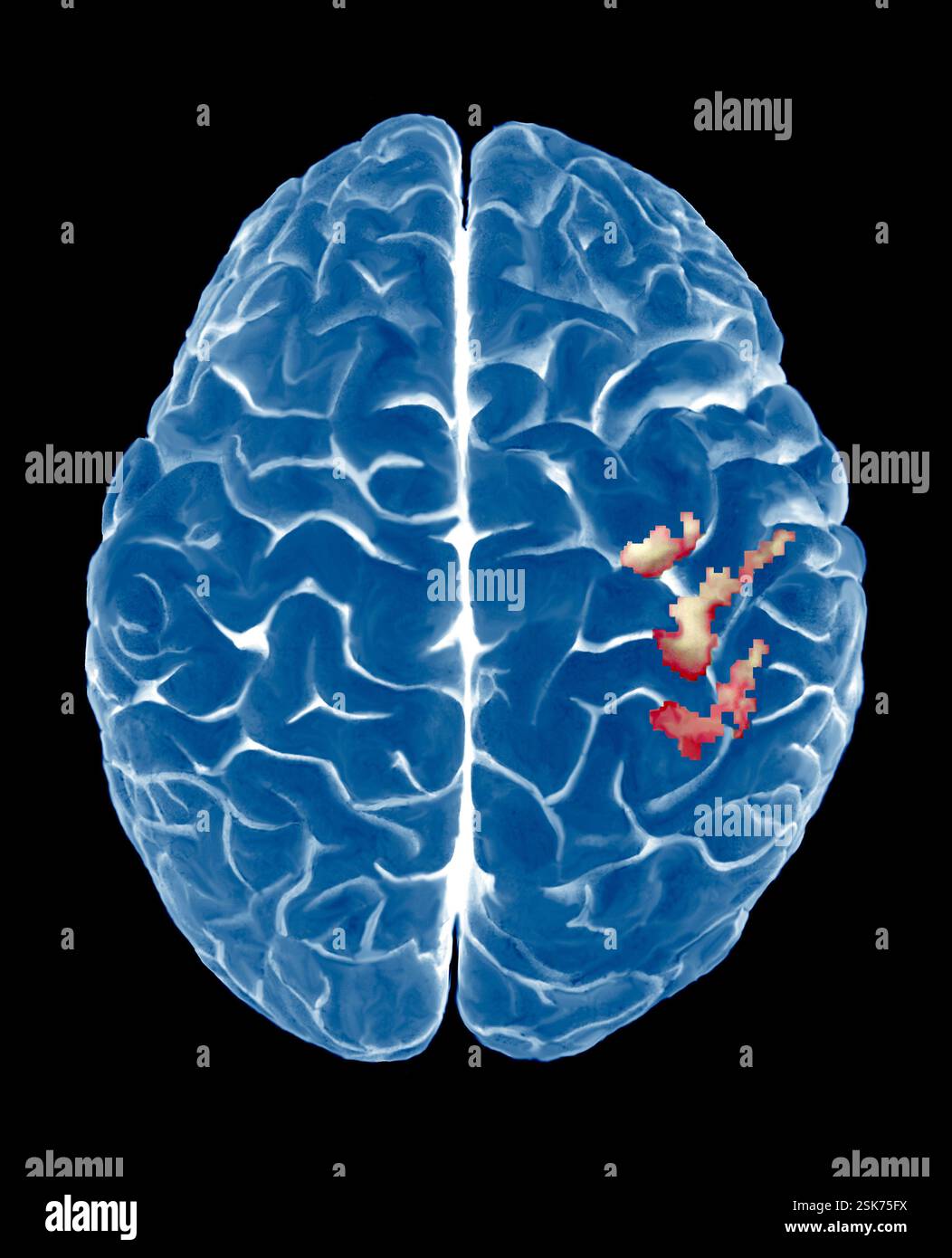 Left hand control, 3-D functional magnetic resonance imaging (fMRI ...