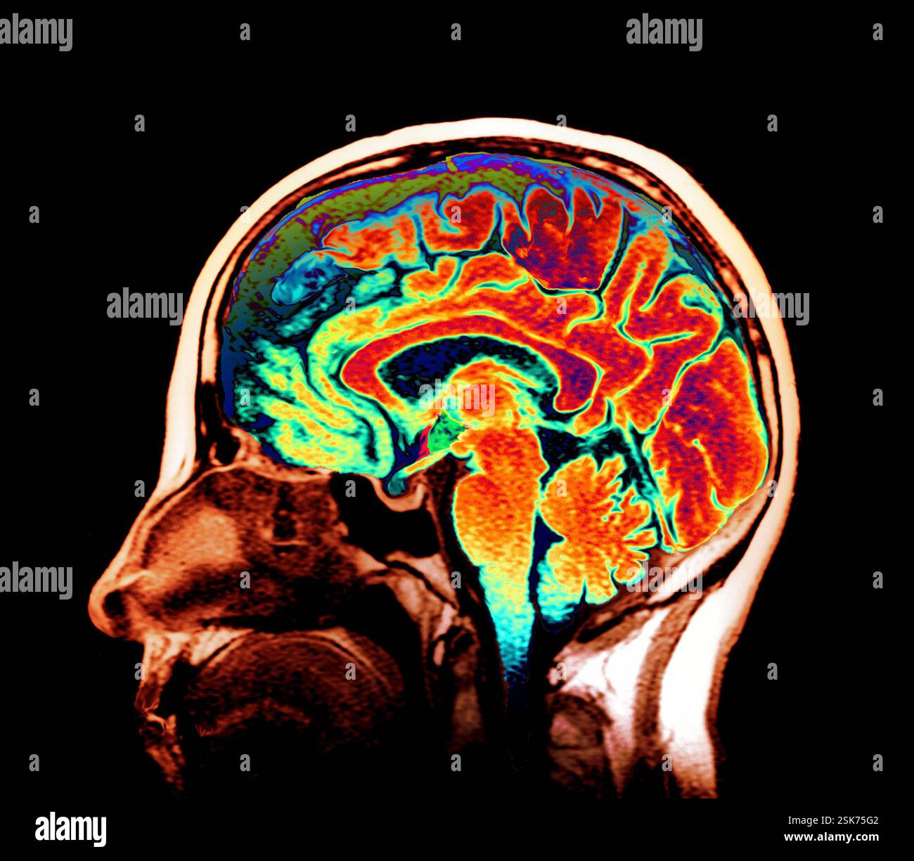 Brain, MRI scan Stock Photo - Alamy