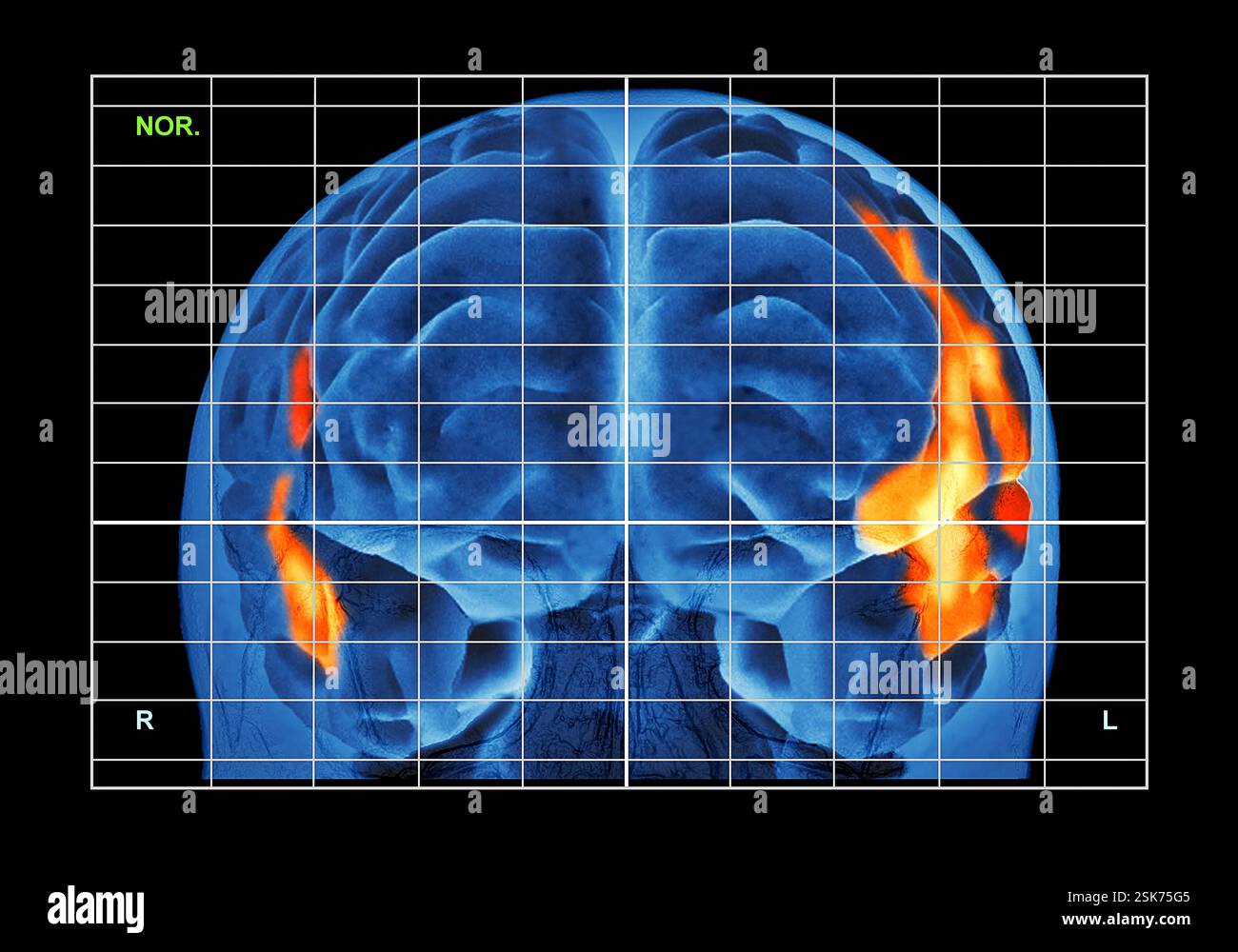 Brain activity during reading aloud. This is a composite of a 3-D ...