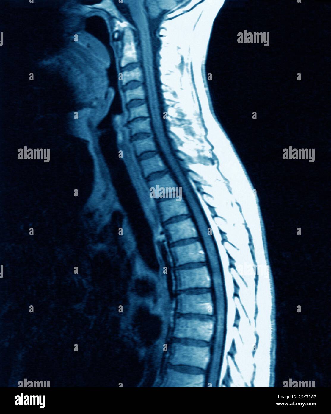 Upper spine. Coloured magnetic resonance imaging (MRI) sagittal scan of ...