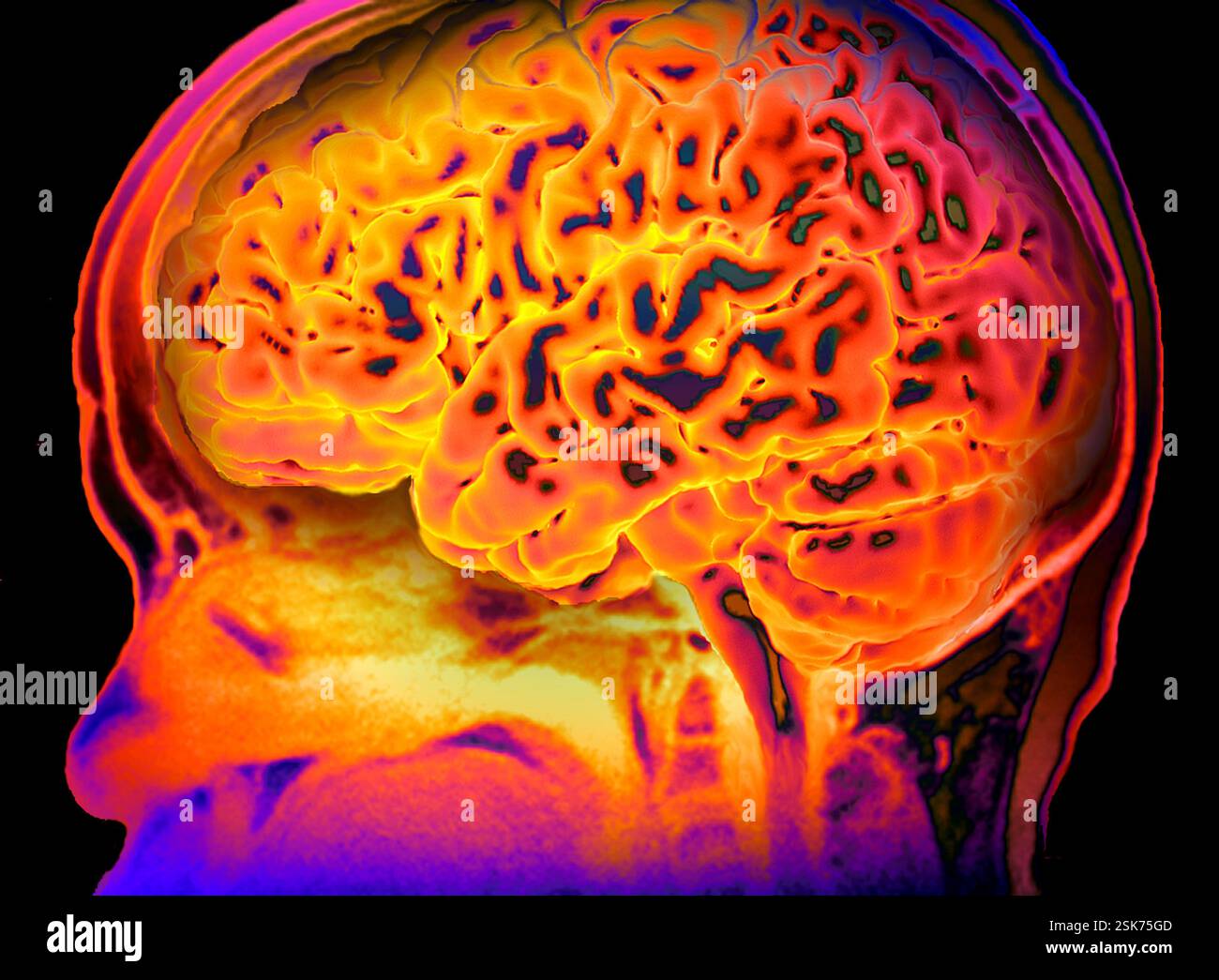 Healthy child's brain, coloured 3-D magnetic resonance imaging (MRI) scan. This is a side view ...