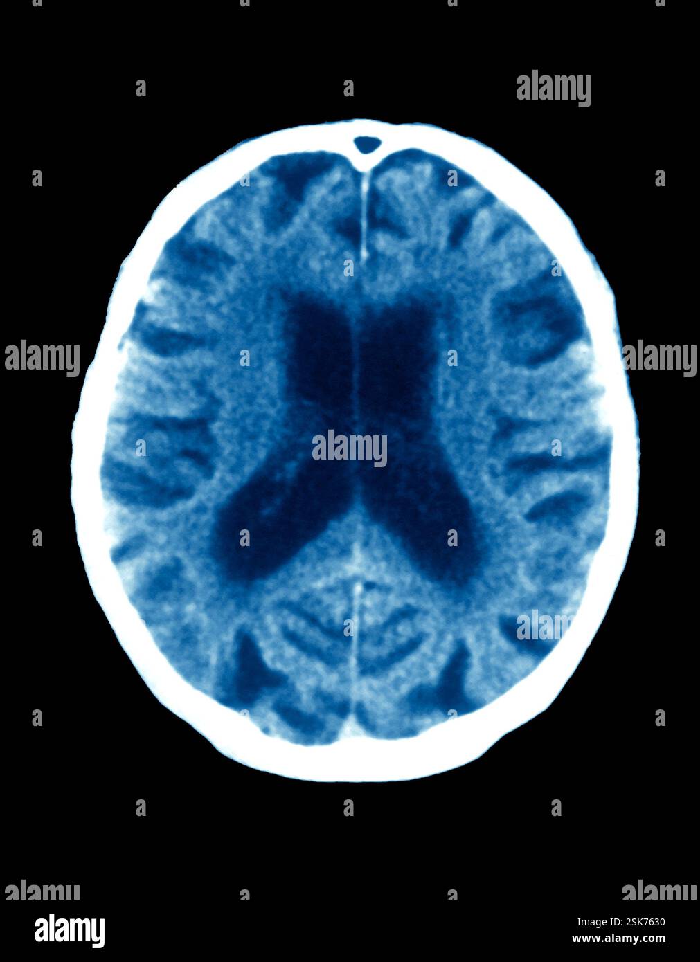 Alzheimer's disease. Coloured computed tomography (CT) scan of an axial ...
