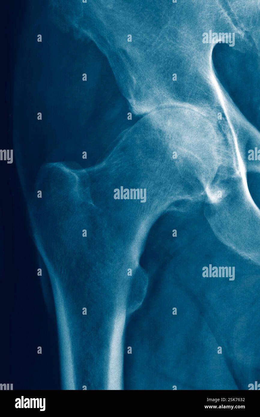 Arthritic hip. Coloured frontal X-ray of the hip of a 62-year-old ...
