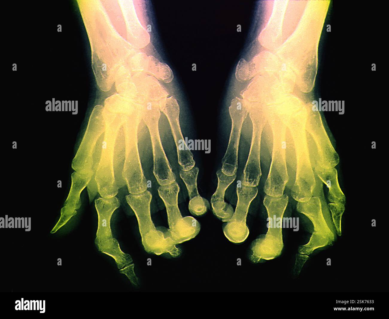 Arthritic hands. Coloured X-ray of the hands of a patient with severe ...