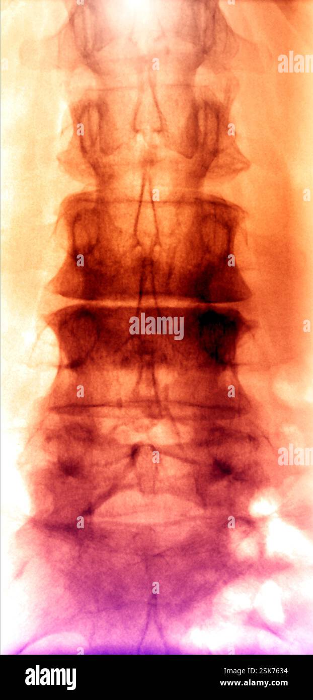 Arthritic spine. Coloured frontal X-ray of the five lumbar vertebrae ...