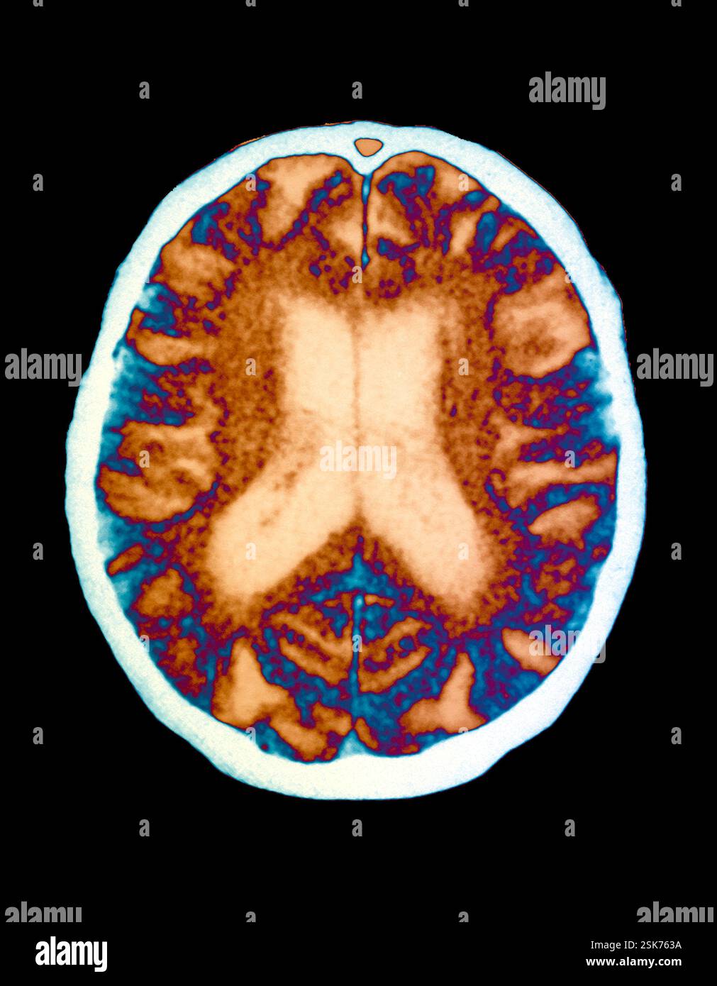Alzheimer's disease. Coloured computed tomography (CT) scan of an axial section through the ...
