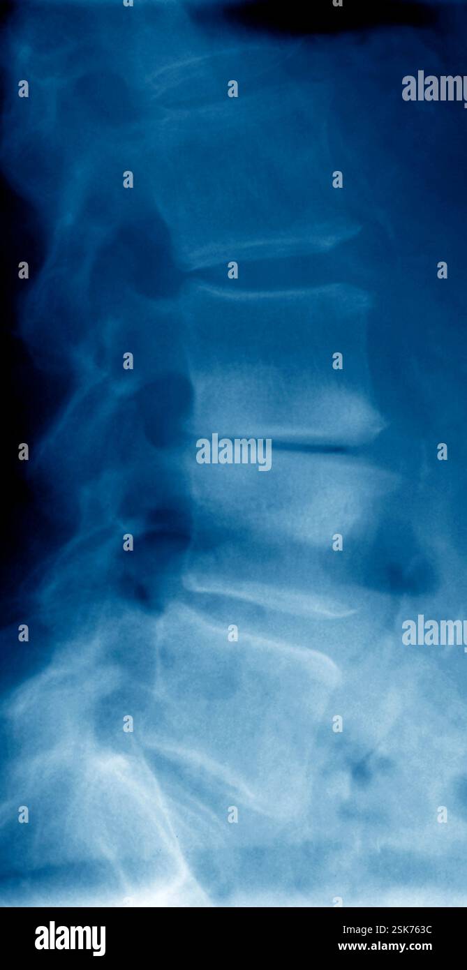 Arthritic spine. Coloured side X-ray of the five lumbar vertebrae (L1 ...
