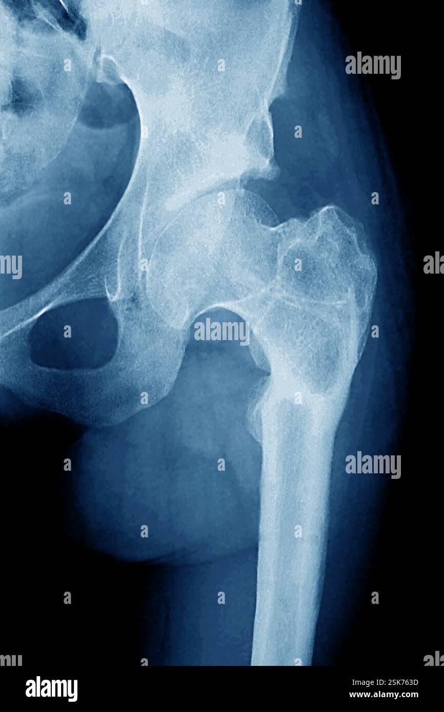Arthritic hip. Coloured frontal X-ray of the hip of a patient with ...