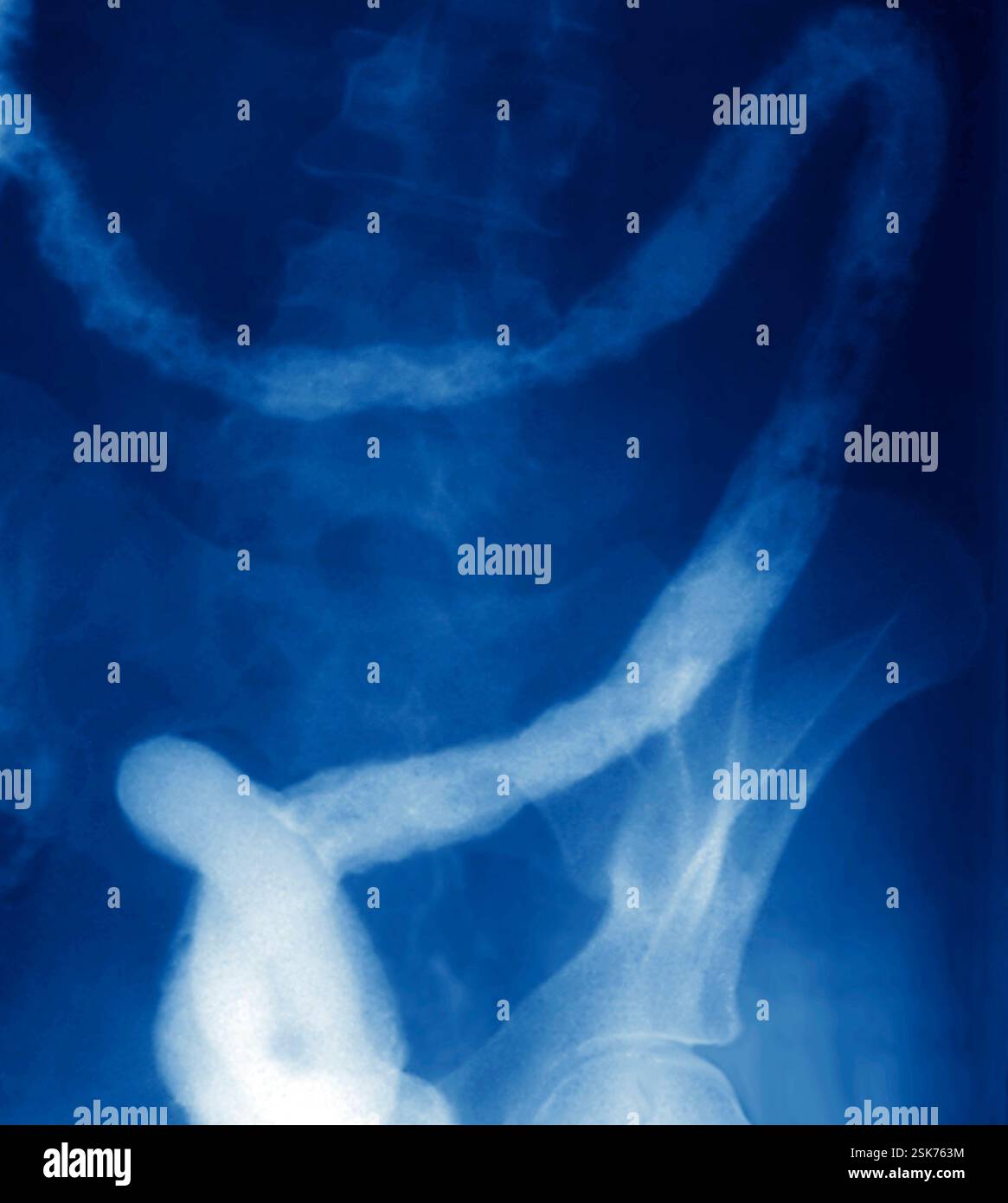 Ulcerative colitis. Coloured barium X-ray of the colon (large intestine ...