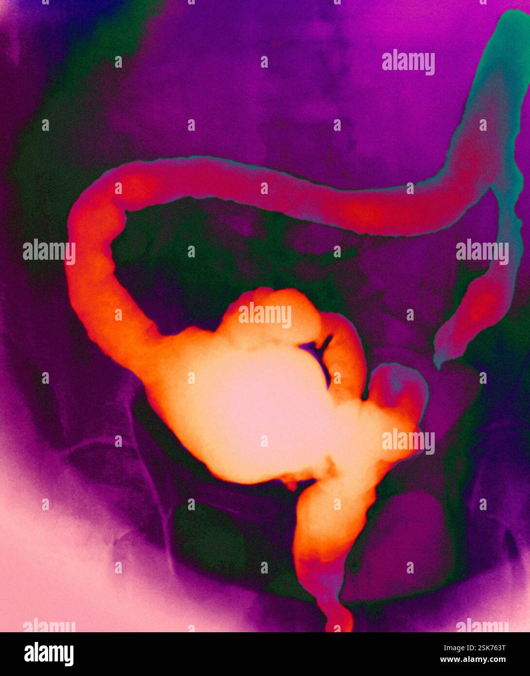 Arteritis in the groin, X-ray Stock Photo - Alamy