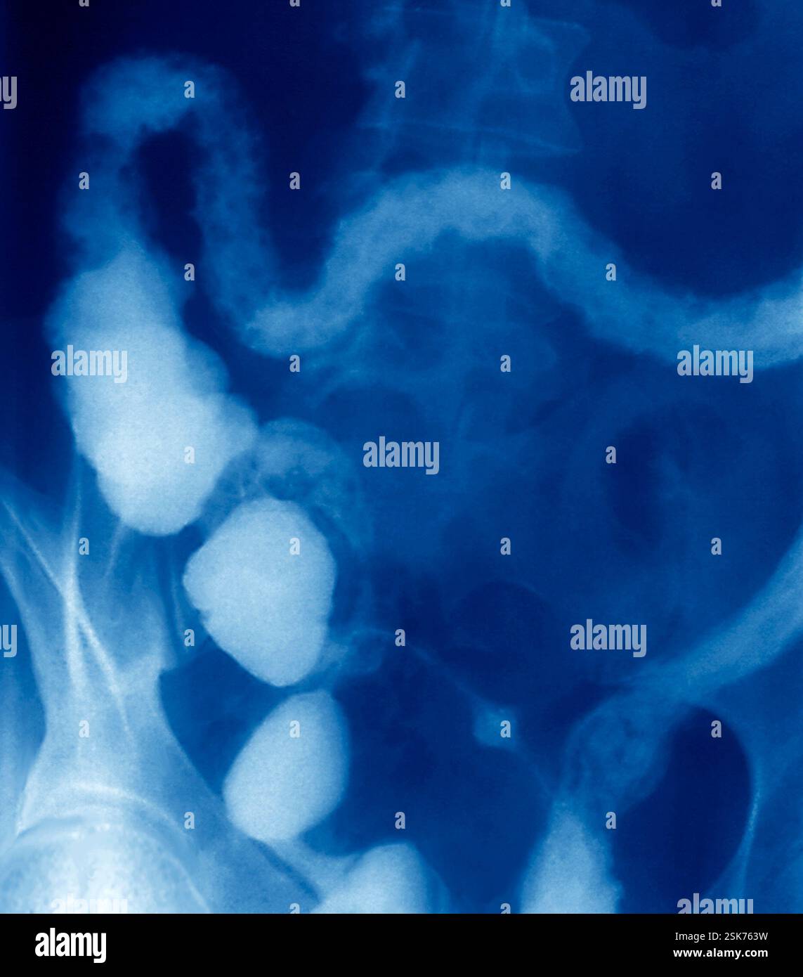 Ulcerative colitis. Coloured barium X-ray of the colon (large intestine ...