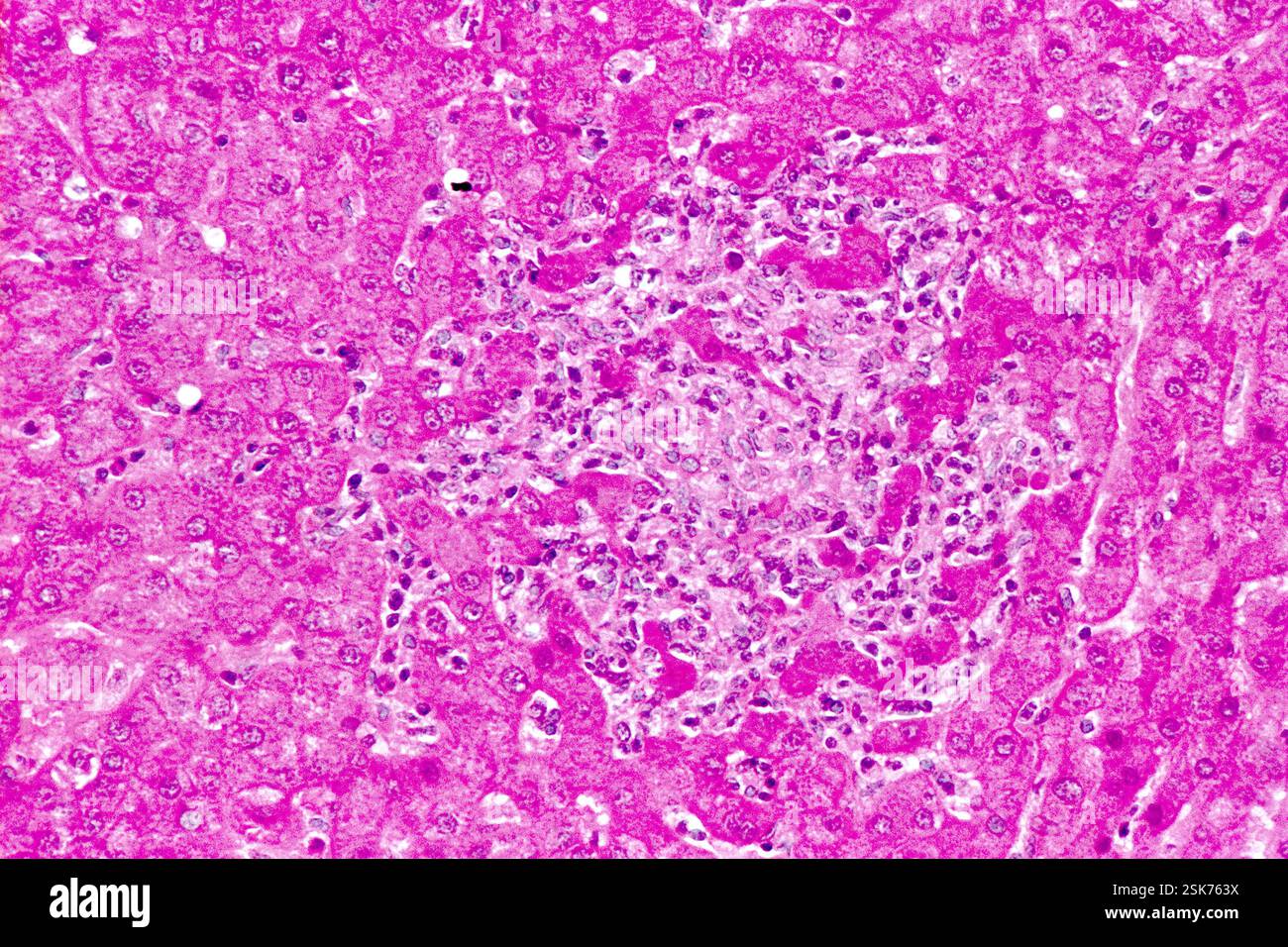 Kaposi's sarcoma. Light micrograph of a malignant (cancerous) tumour ...