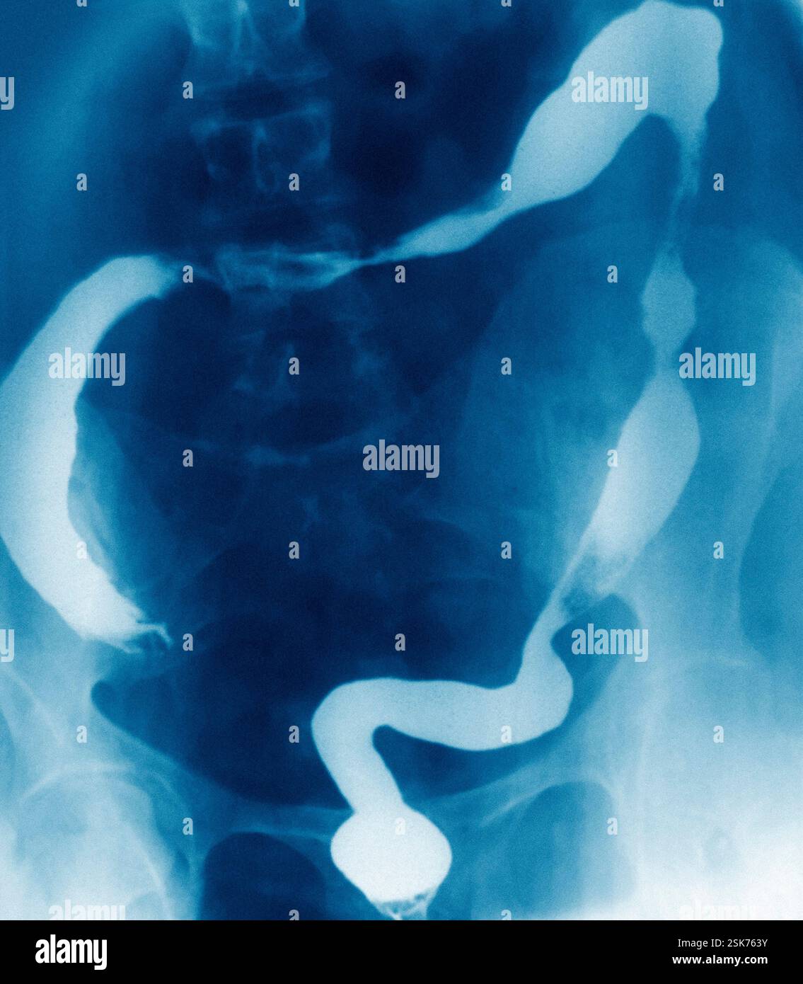 Stent in the abdominal aorta, X-ray Stock Photo - Alamy