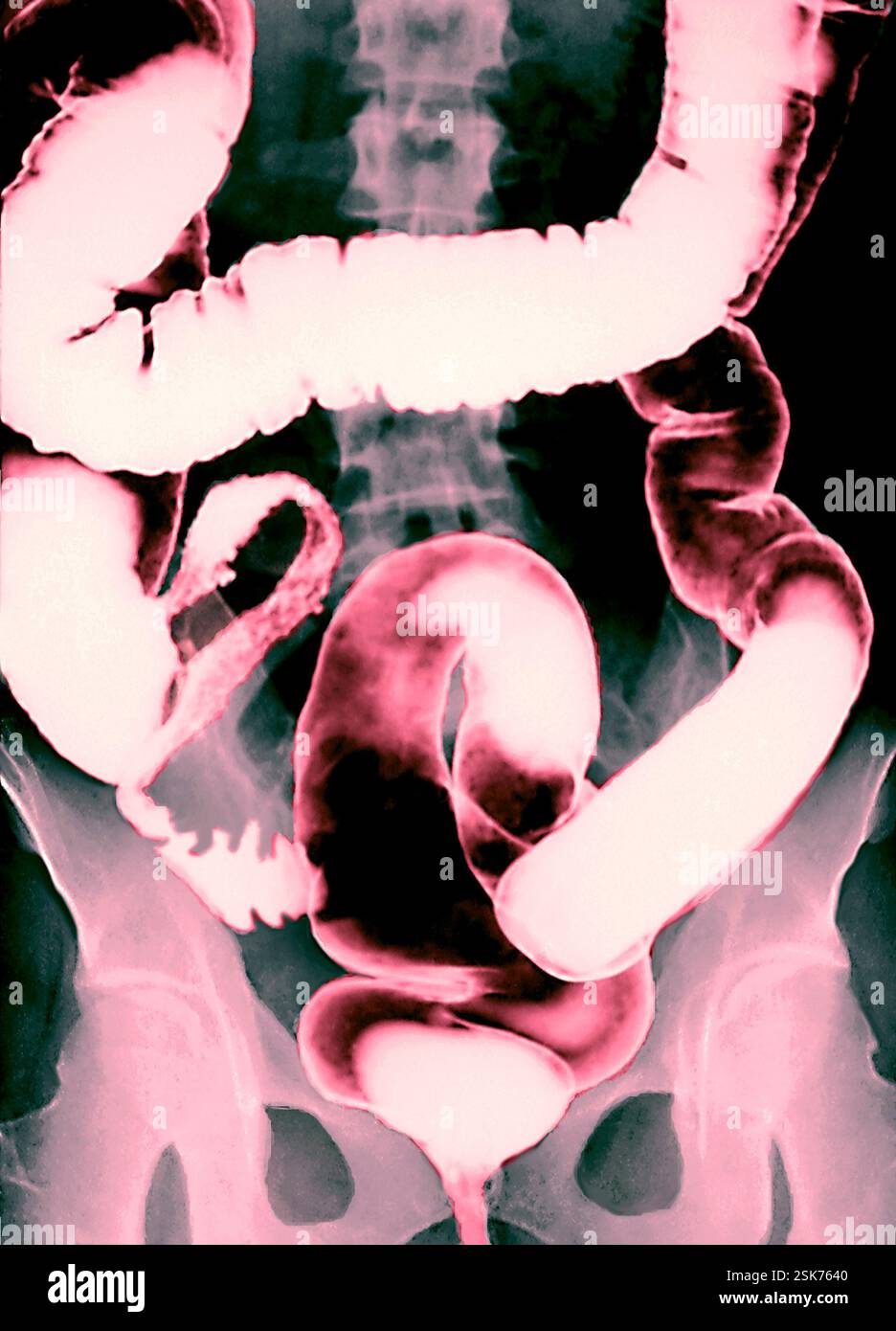 Crohn's disease, coloured double contrast barium enema X-ray. Crohn's ...