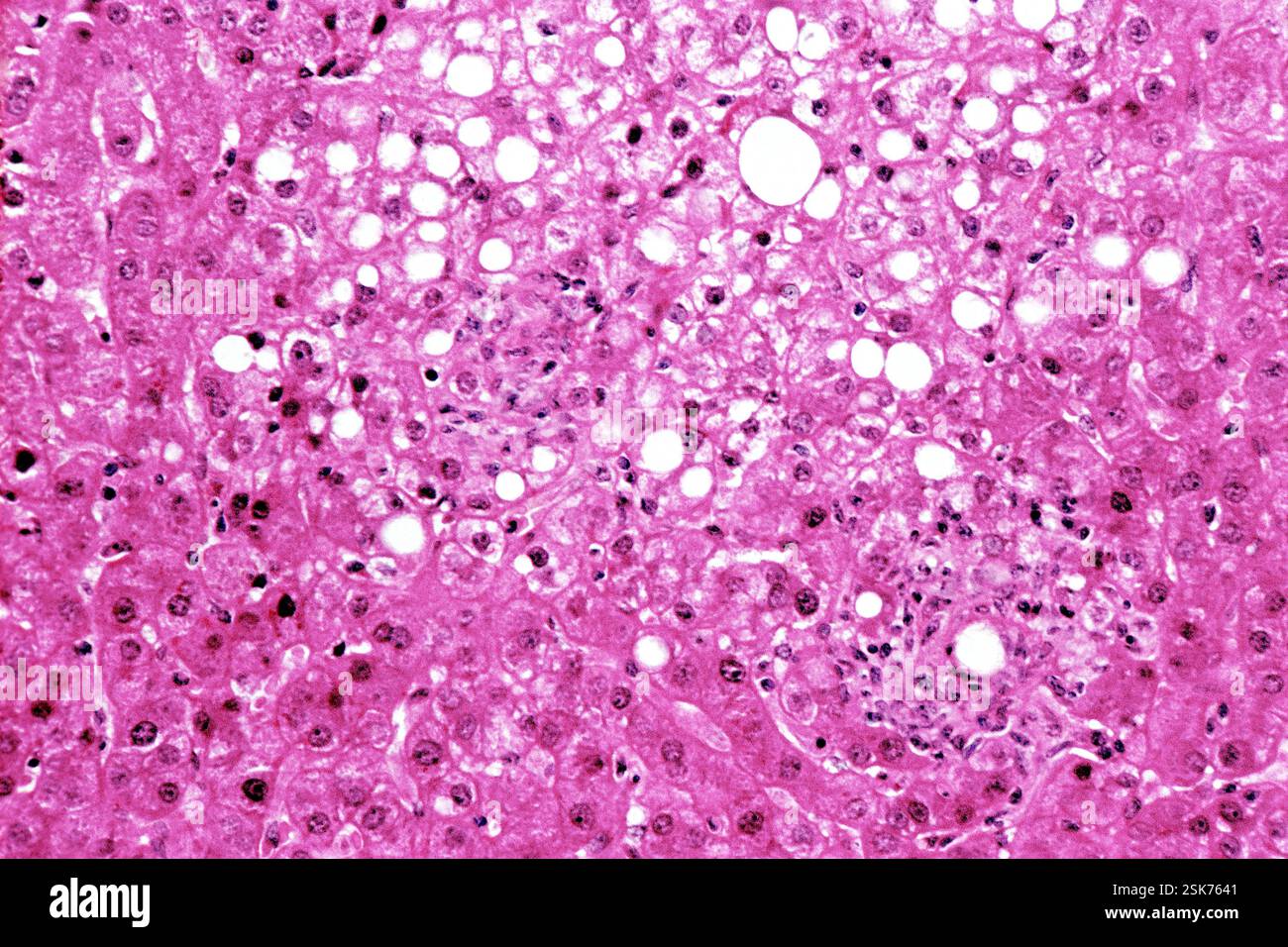Kaposi's sarcoma. Light micrograph of a malignant (cancerous) tumour ...