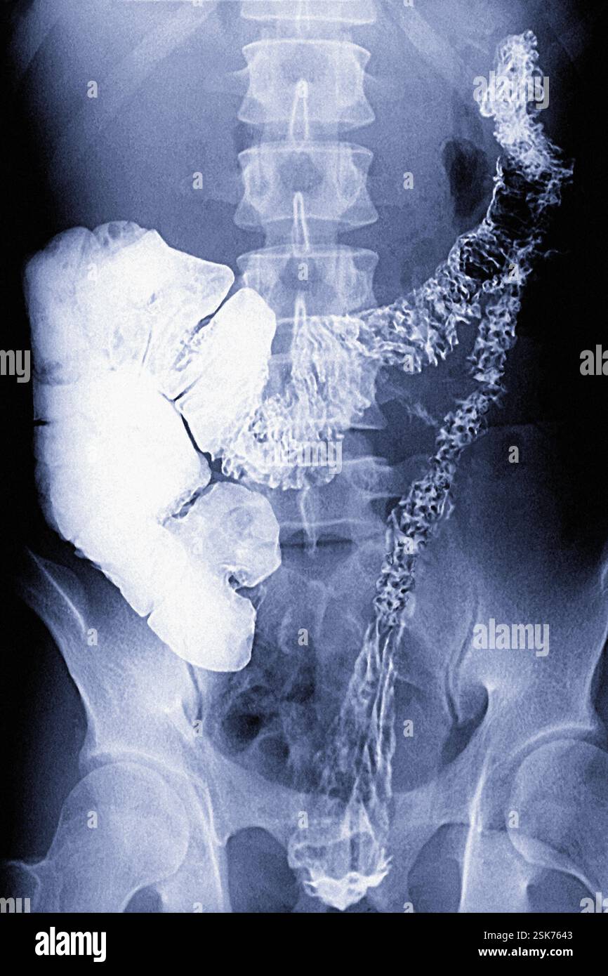 Ulcerative colitis. Barium X-ray of the colon (large intestine) of a ...