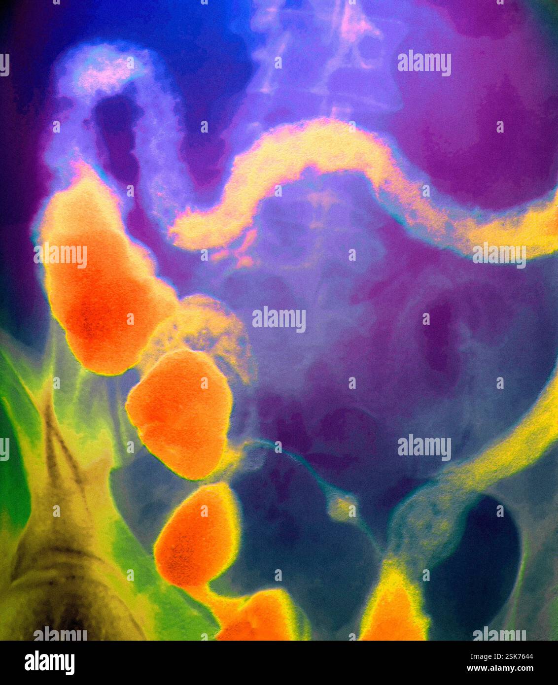 Ulcerative colitis. Coloured barium X-ray of the colon (large intestine ...