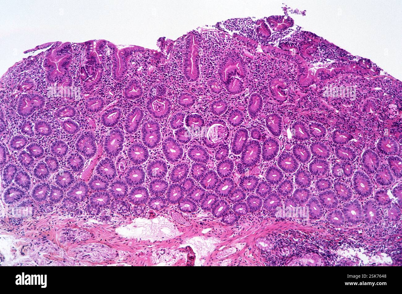 Coeliac disease. Light micrograph of a section through the duodenum of ...