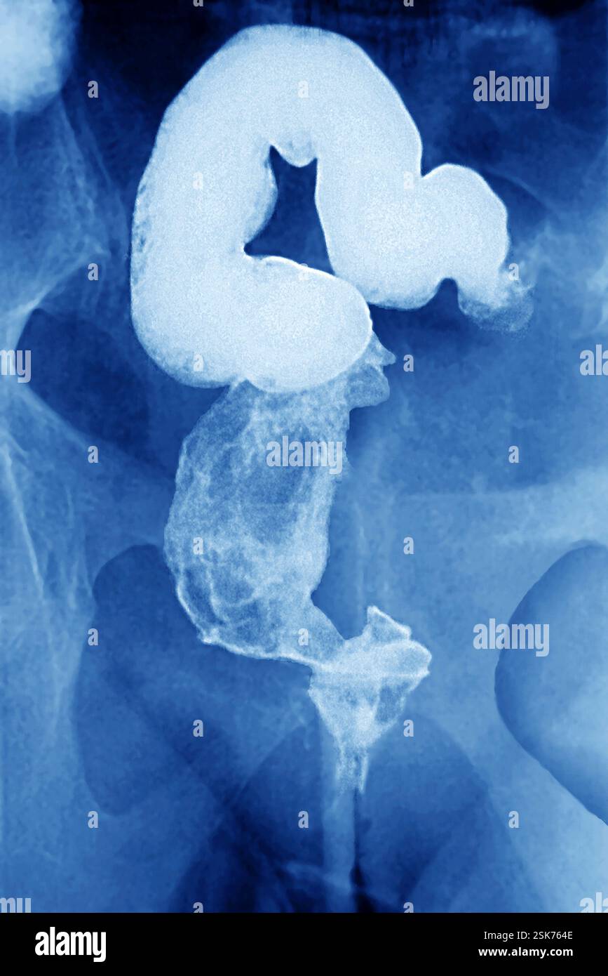Rectal cancer. Coloured barium X-ray of the abdomen of a patient with ...