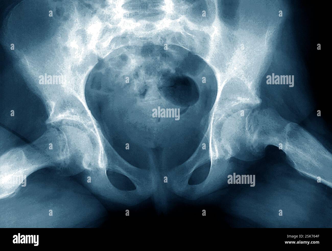 Bone growth disorder. Frontal X-ray of the hip joints of a child with ...