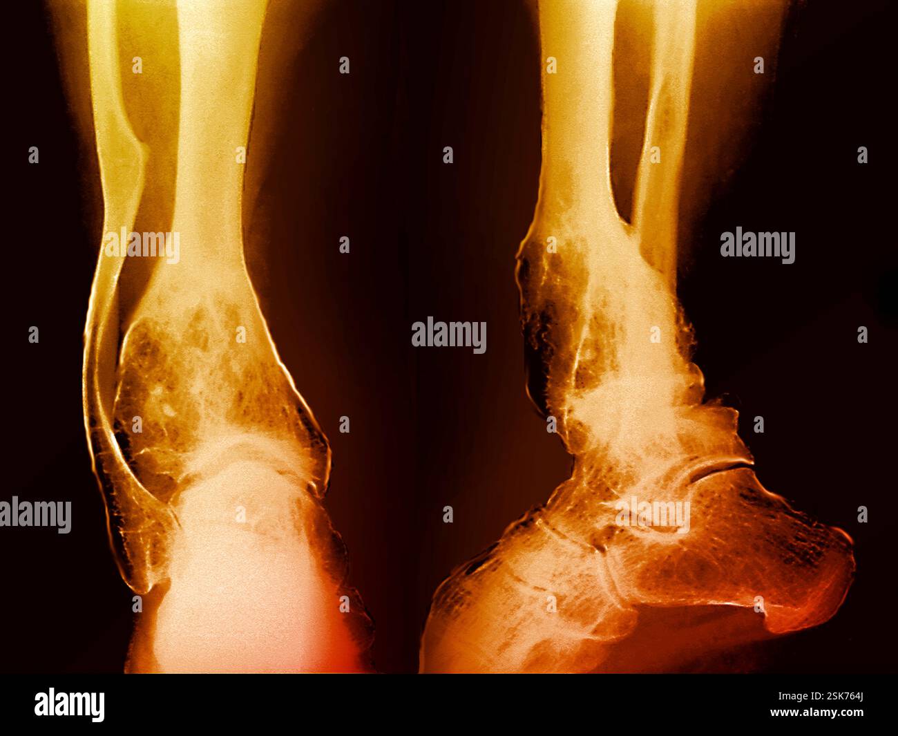 Bone growth disorder. Coloured X-rays of one of the ankles of a patient ...