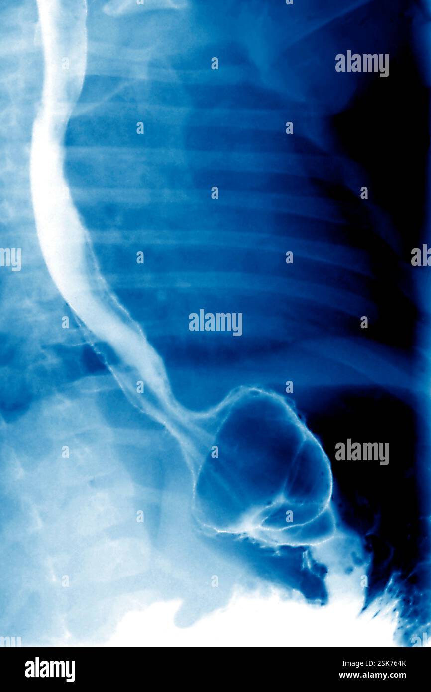 Hiatus hernia. Coloured X-ray of a side-view of a patient with a hiatus ...