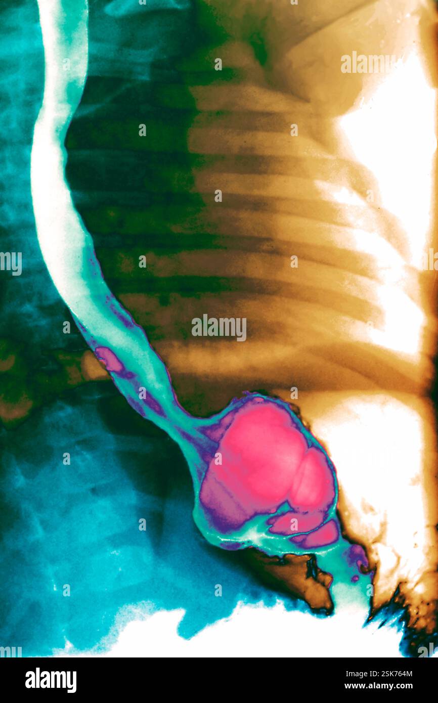 Hiatus hernia. Coloured X-ray of a side-view of a patient with a hiatus ...