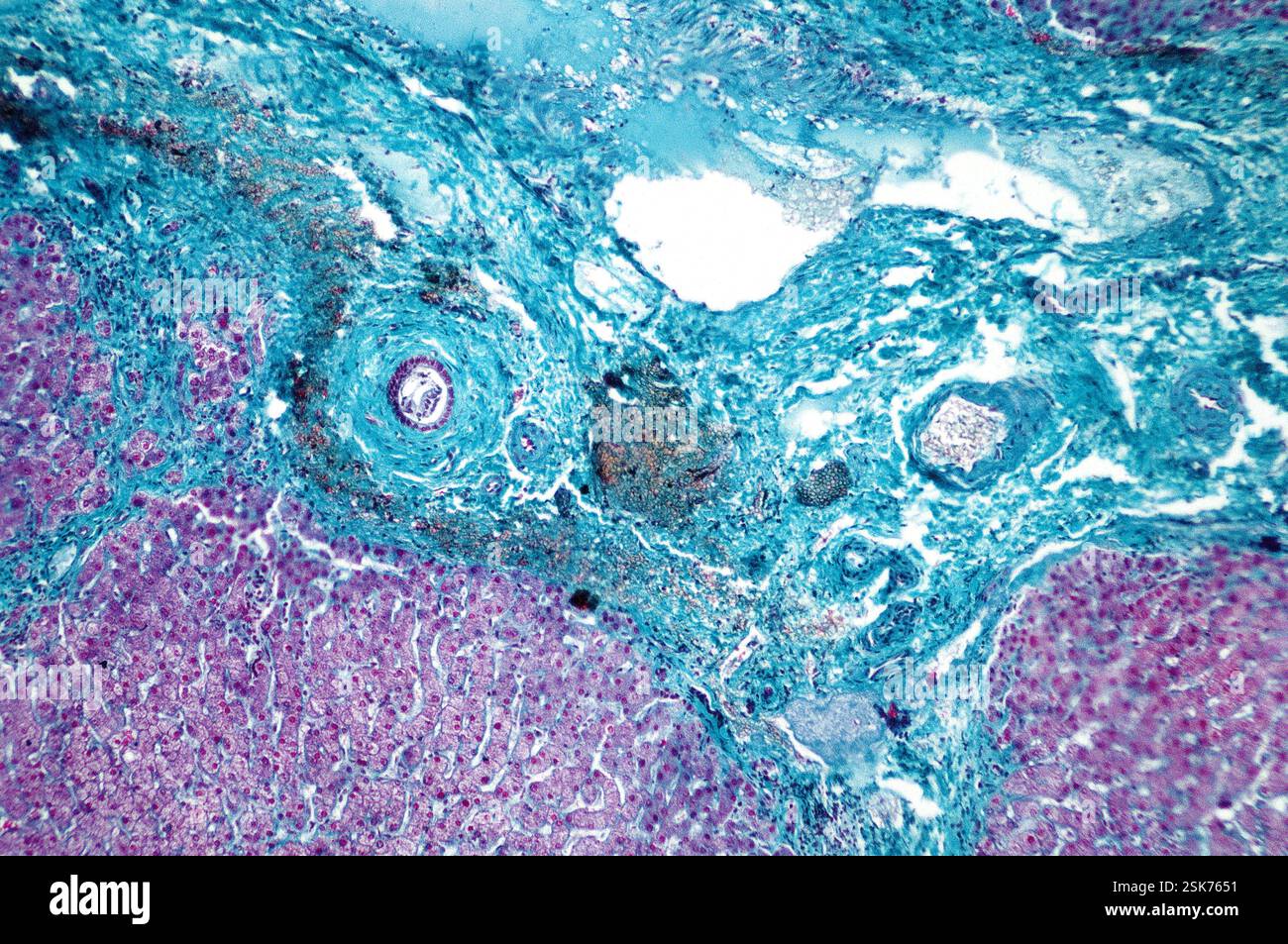 Thrombosis of a groin artery, X-ray Stock Photo - Alamy