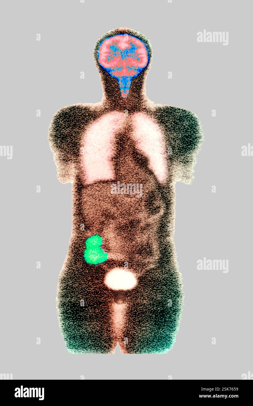 Berger's disease, light micrograph Stock Photo - Alamy