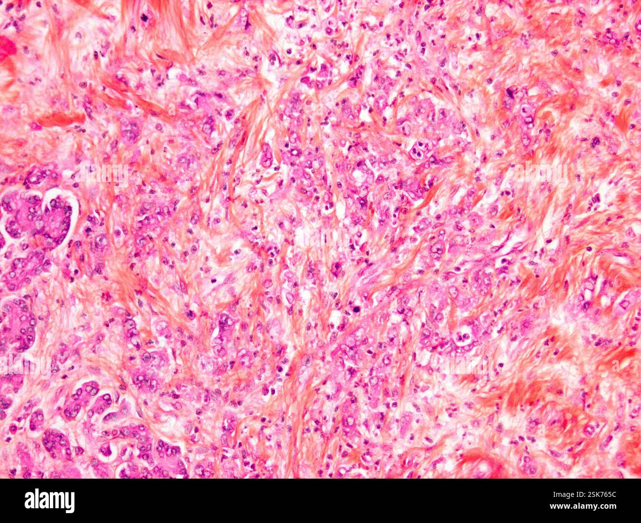 Pancreatic cancer. Light micrograph of a section through the pancreas ...