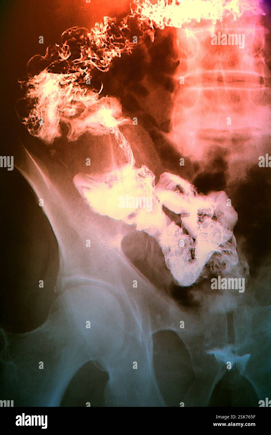 Colon cancer, coloured barium enema X-ray. The X- ray reveals the ...
