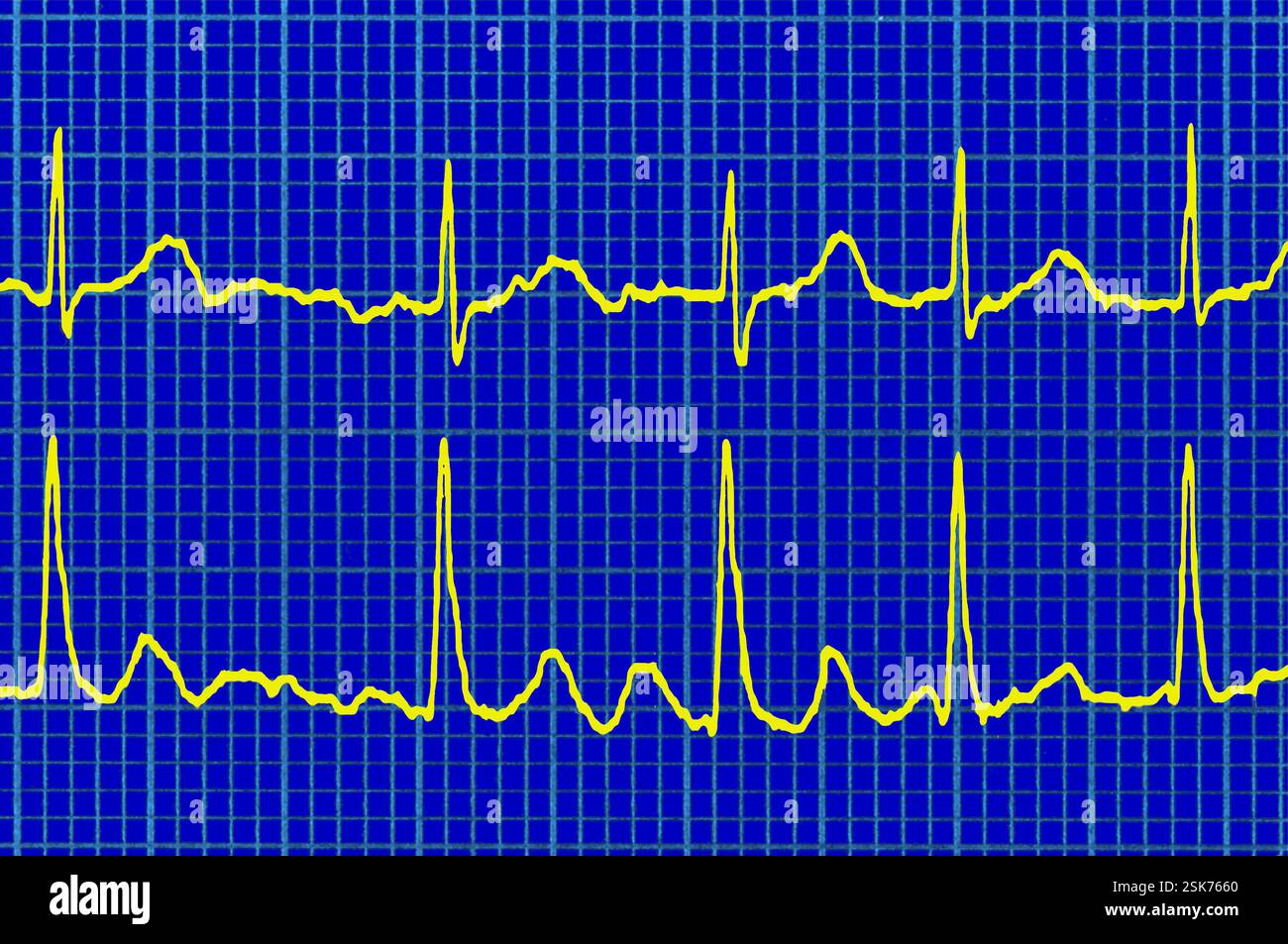 Swollen fallopian tubes, X-ray Stock Photo - Alamy