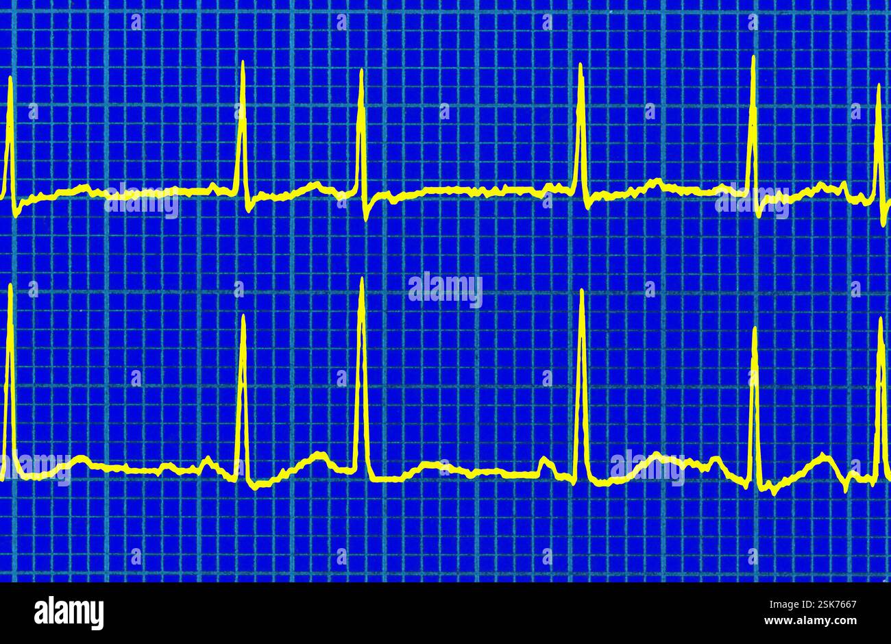 Irregular heartbeat. Electrocardiogram (ECG) of electrical activity ...