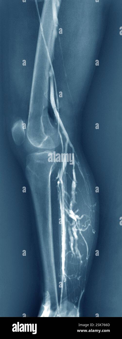 Blocked fallopian tubes, X-ray Stock Photo - Alamy