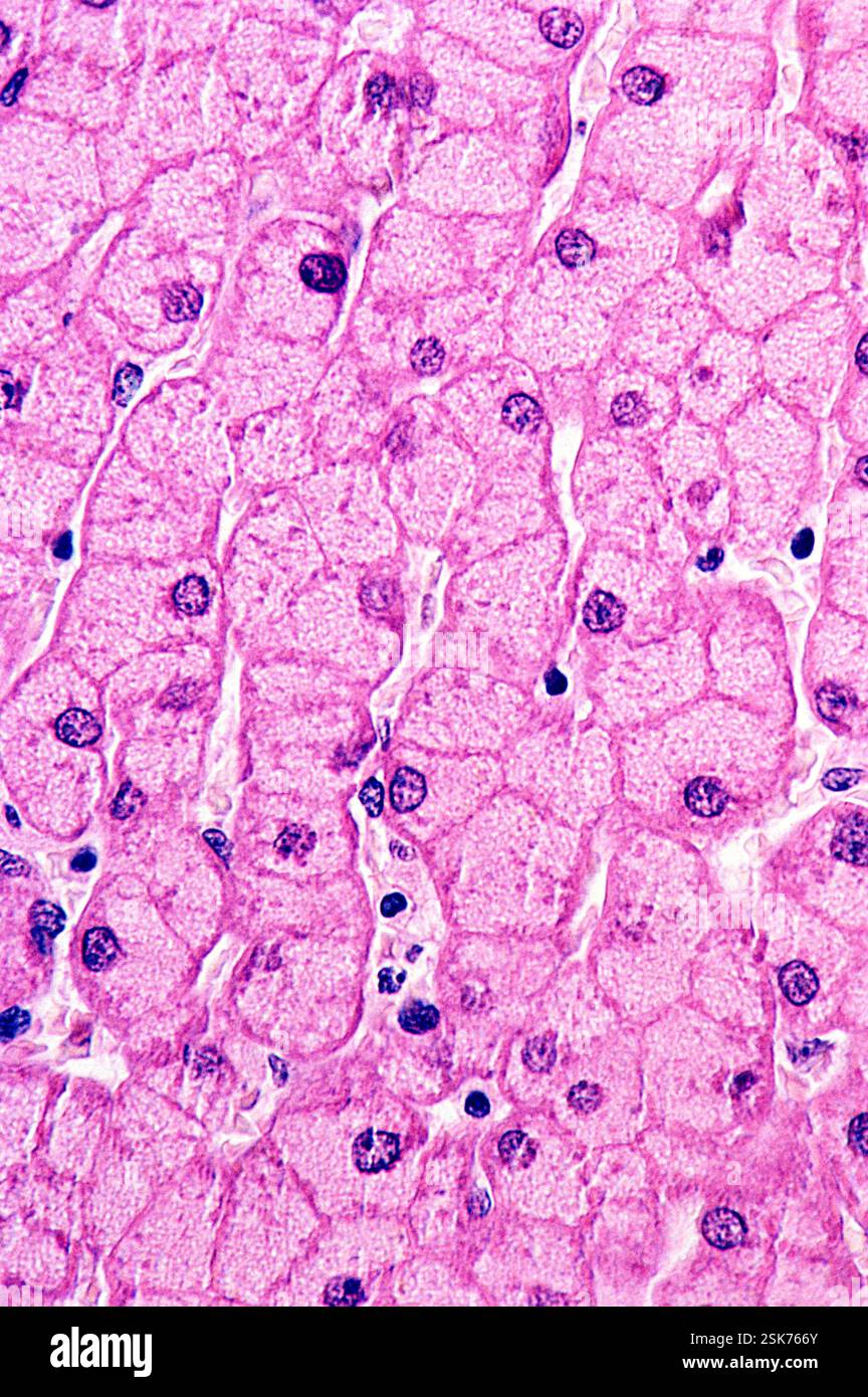 Stent in a coronary artery, X-ray Stock Photo - Alamy