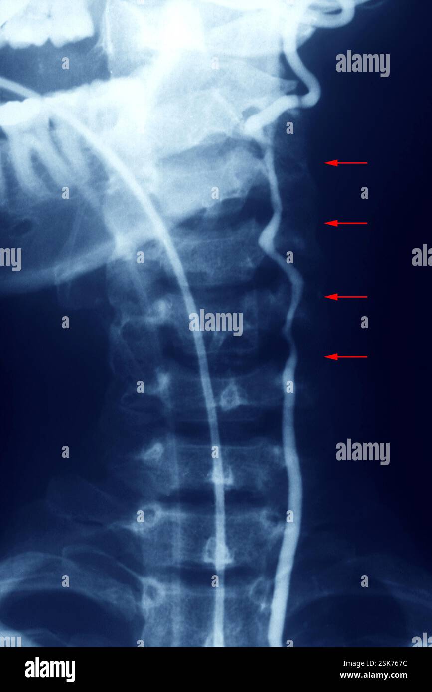 Blocked fallopian tube, X-ray Stock Photo - Alamy