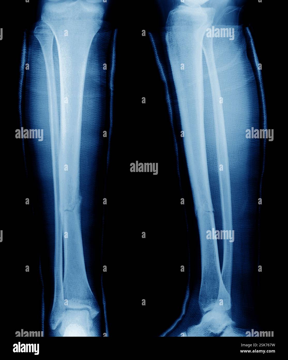 Fractured shin bone. Coloured X-rays of a fracture of the tibia (shin ...