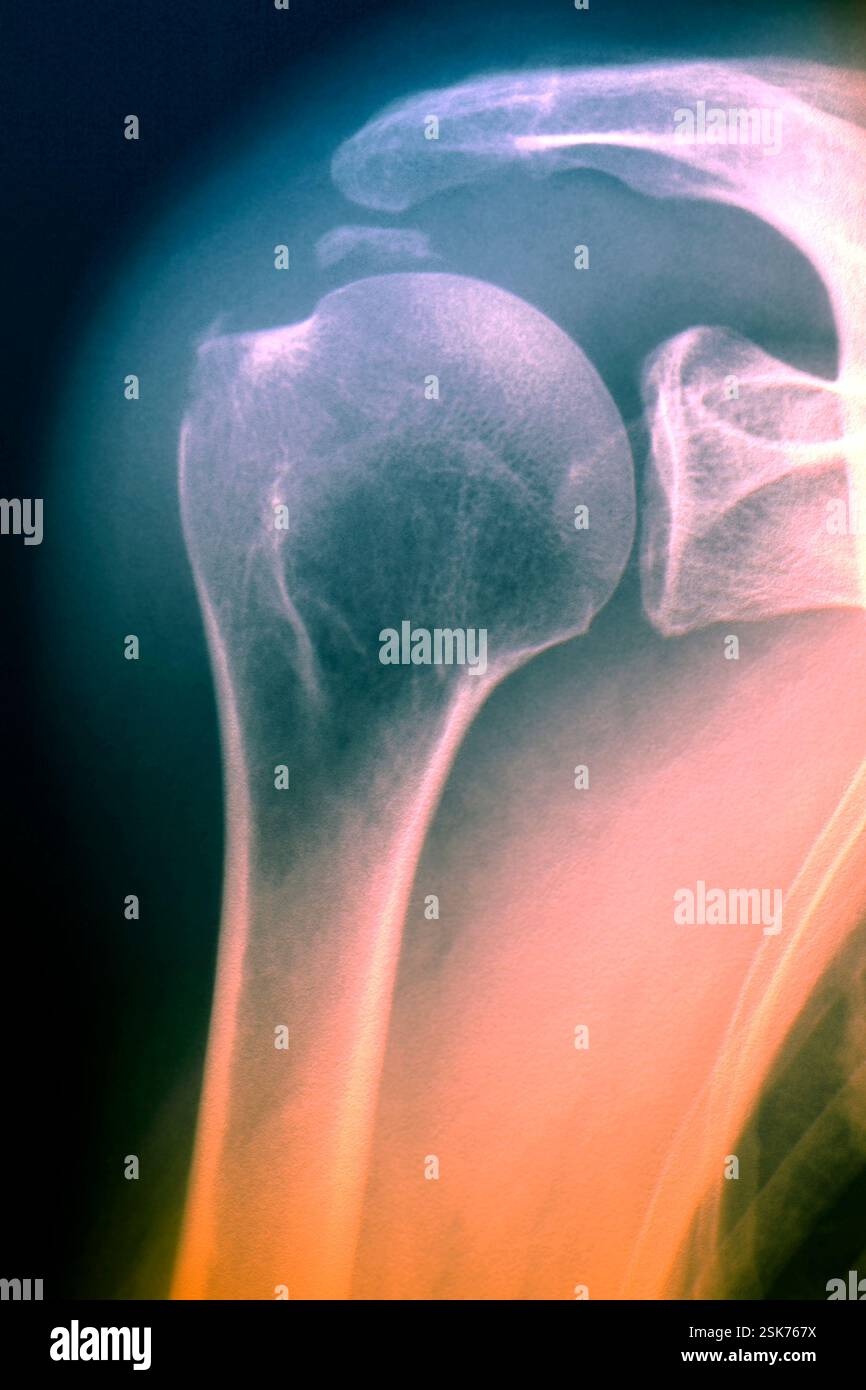 Fractured shoulder. Coloured frontal X-ray of the shoulder bones of a ...
