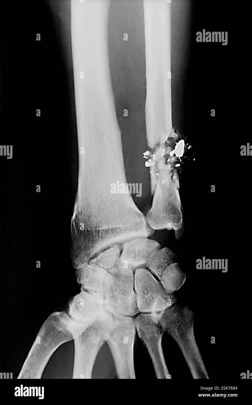 Fractured wrist. X-ray of the wrist of a patient with a fracture ...