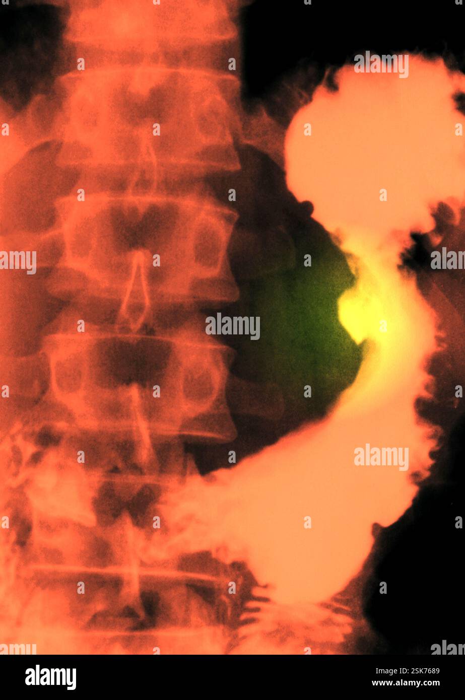 Twin foetuses, ultrasound scan Stock Photo - Alamy