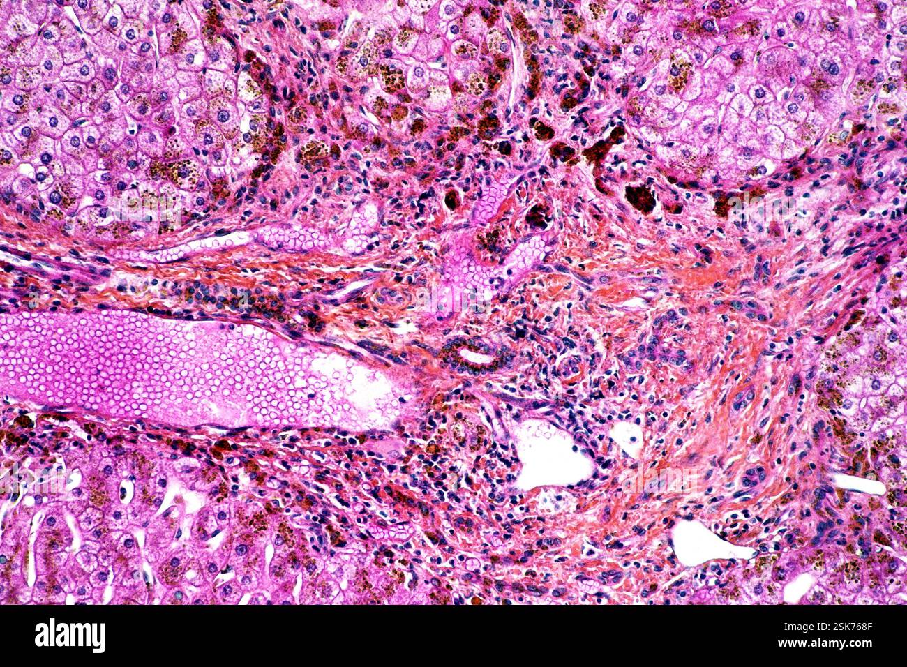 Spinal collapse treatment, X-ray Stock Photo - Alamy