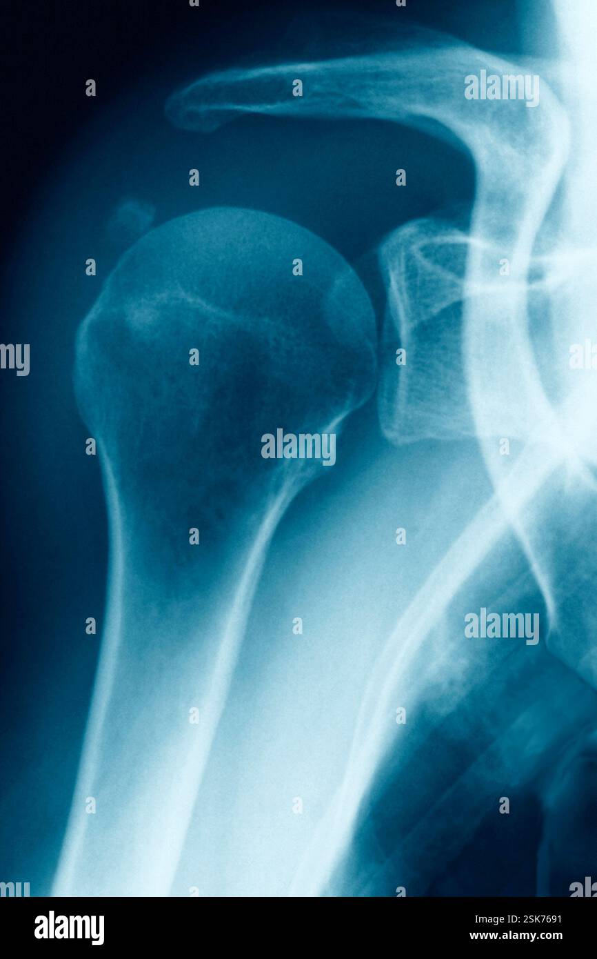 Fractured shoulder. Coloured frontal X-ray of the shoulder bones of a ...