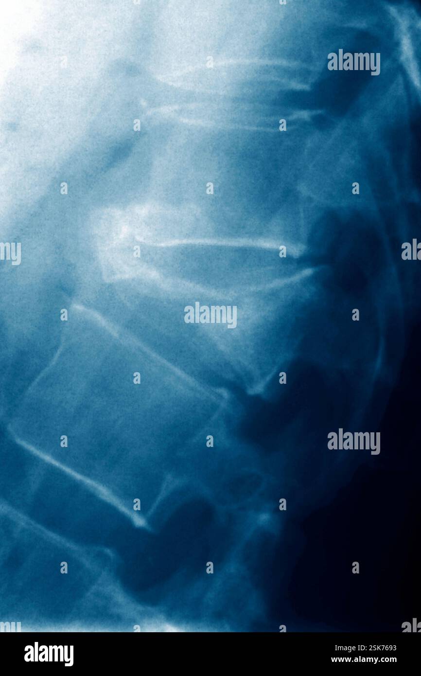 Healthy colon, barium X-ray Stock Photo - Alamy